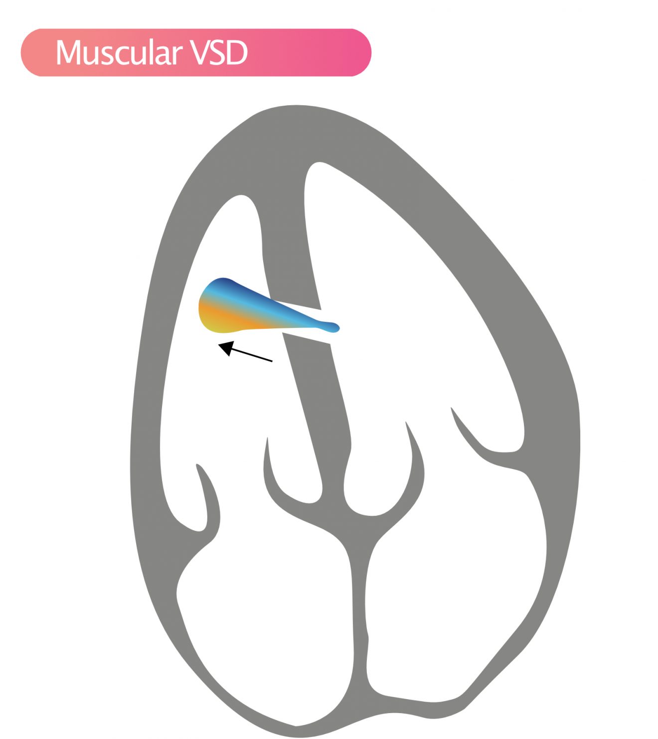 Congenital heart disease & GUCH (Grown Up Congenital Heart disease)