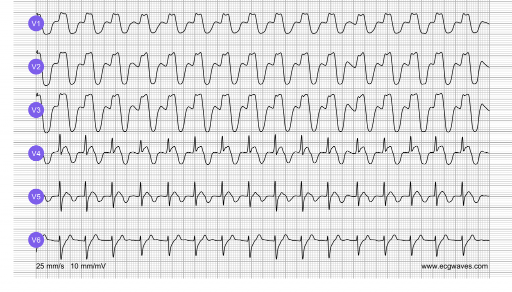 ECG Test (Quiz) Library: Question 1, ECG 2 – The Cardiovascular