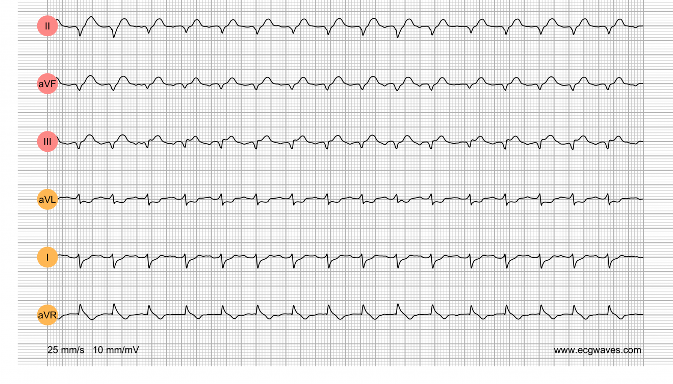ECG Test (Quiz) Library: Question 1 – The Cardiovascular