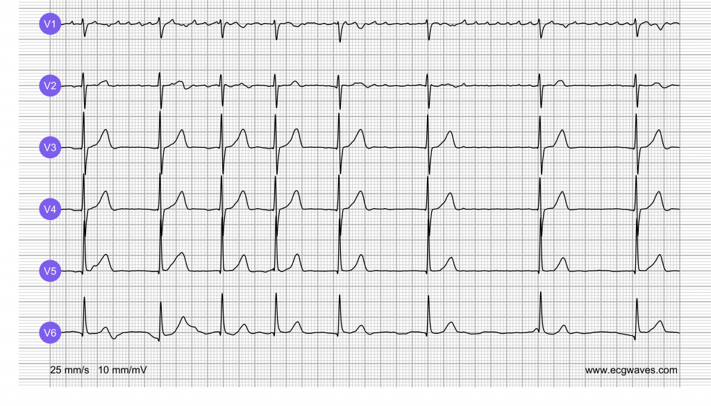ECG Test (Quiz) Library: Question 3 – The Cardiovascular