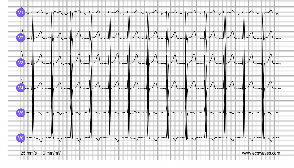 ECG Test (Quiz) Library: Question 6 – The Cardiovascular
