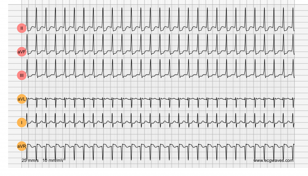 ECG Test (Quiz) Library: Question 7 – The Cardiovascular