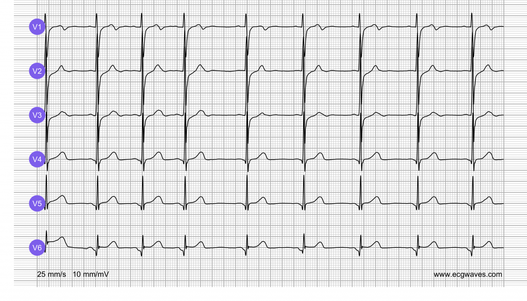 ECG Test (Quiz) Library: Question 8 – The Cardiovascular