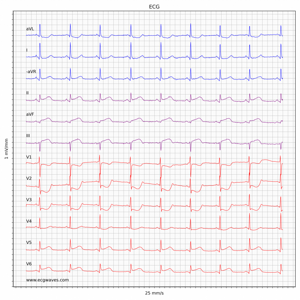 ECG Test 3 – Question 1 – The Cardiovascular