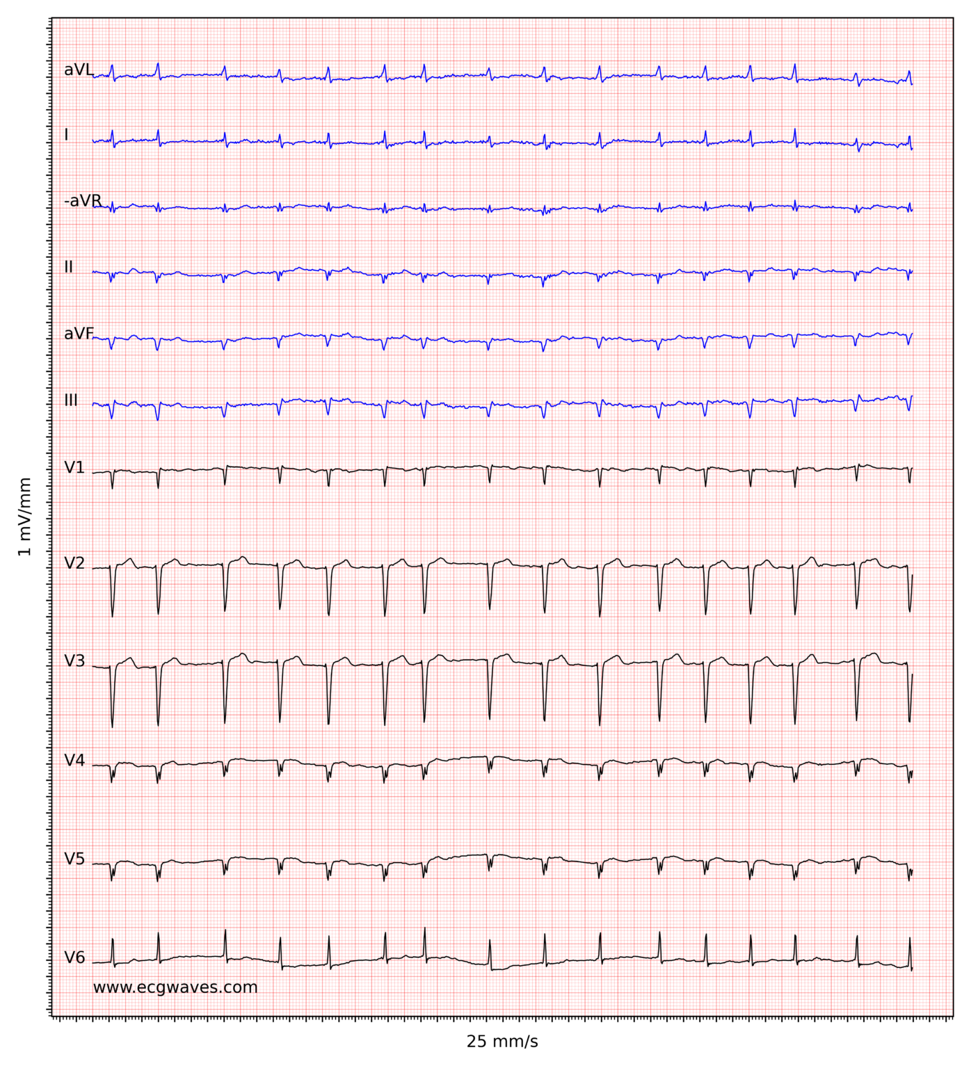 Atrial Fibrillation Ecg Classification Causes Risk Factors
