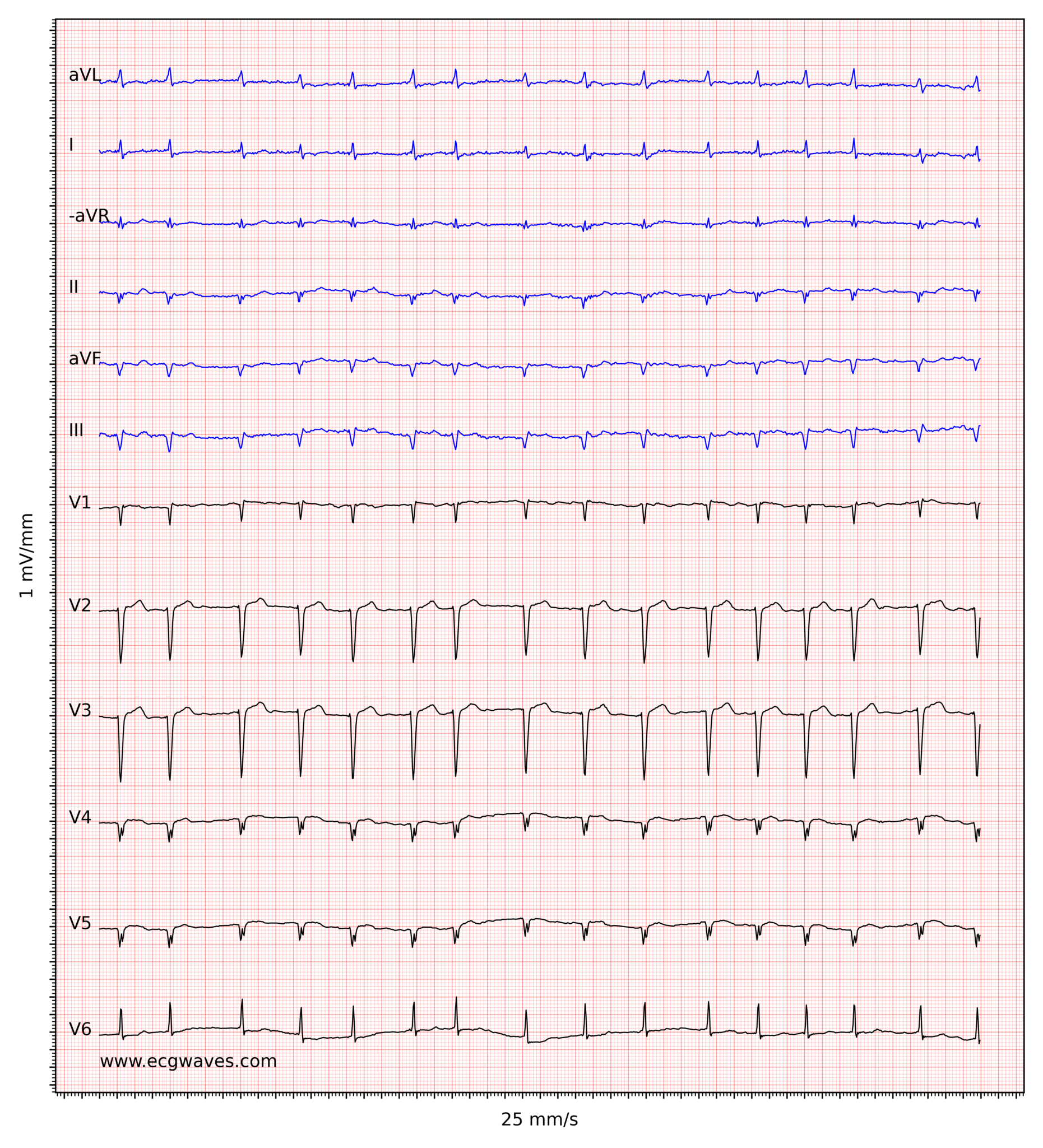Atrial fibrillation: ECG, classification, causes, risk factors ...