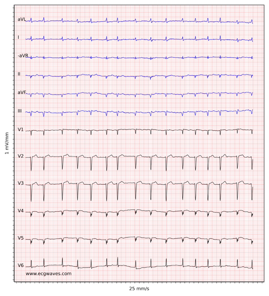 Atrial fibrillation: ECG, classification, causes, risk factors ...