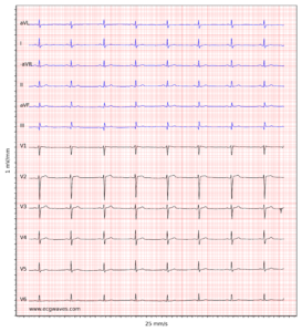 Sinus bradycardia: definitions, ECG, causes and management