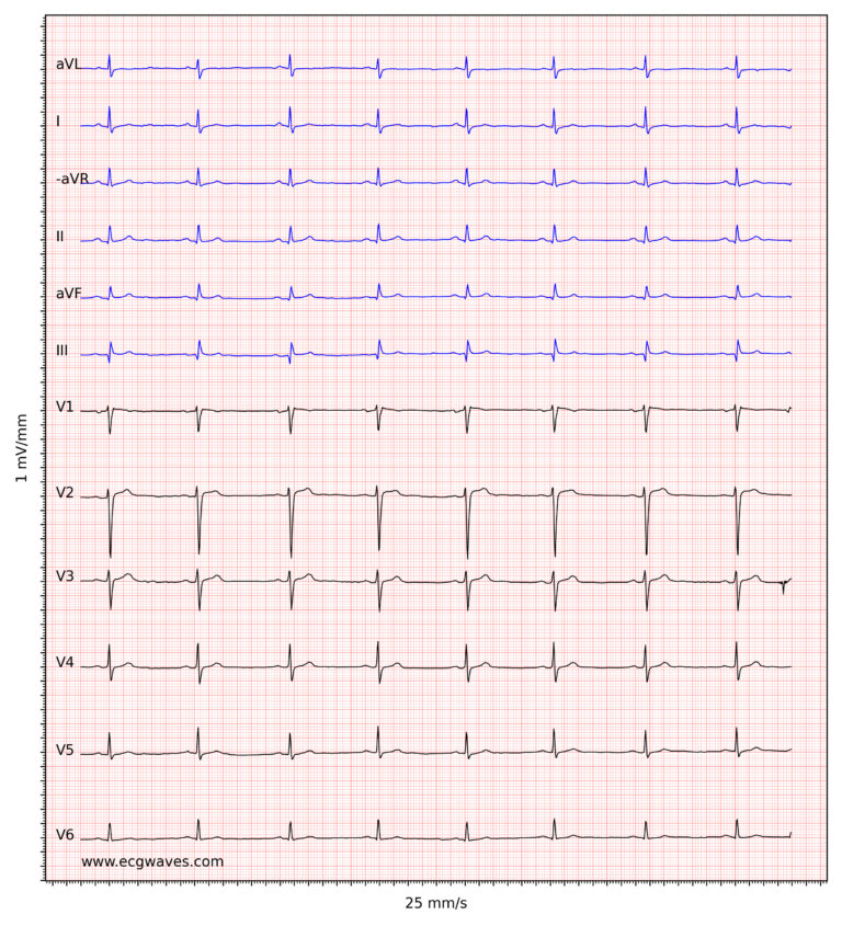 Sinus bradycardia: definitions, ECG, causes and management