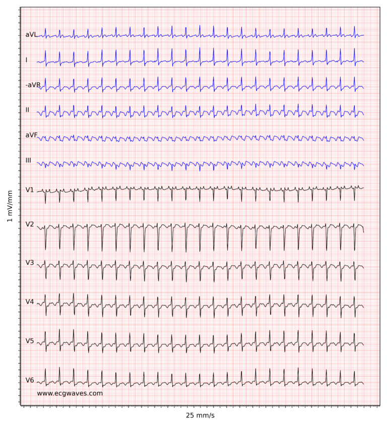 Atrial Flutter Classification Causes Ecg Diagnosis And Management