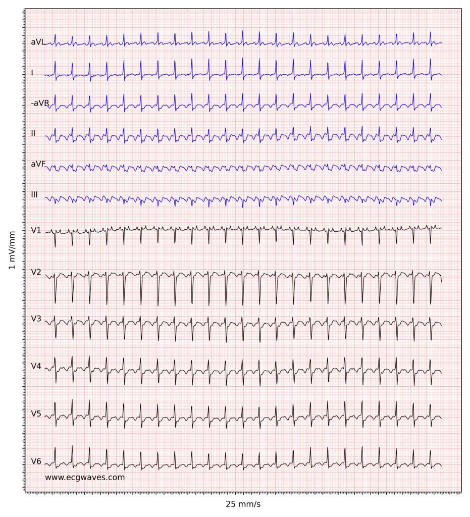 ECG-abnormal-QRS-atrial-flutter – The Cardiovascular