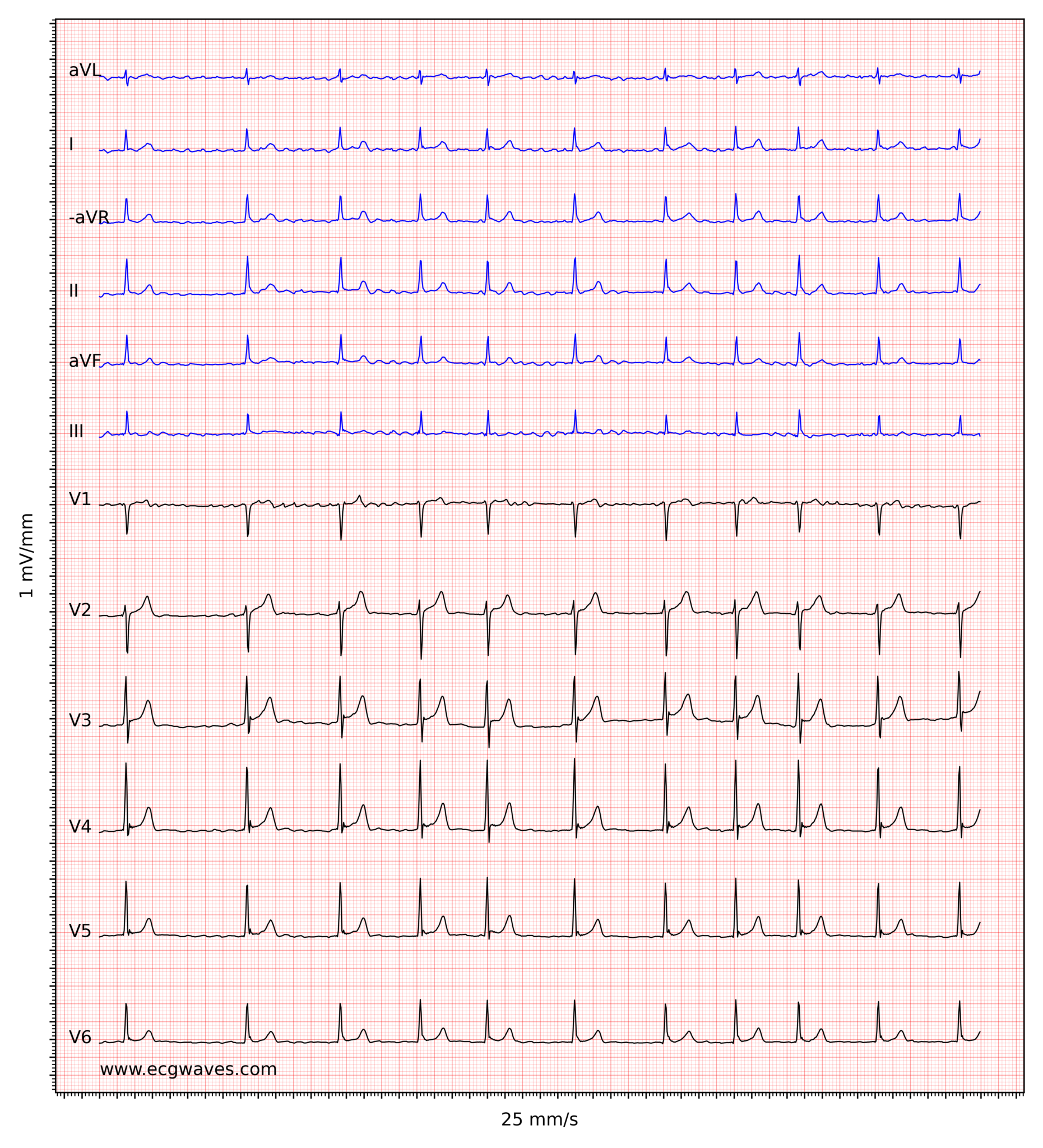 ECG-atrial-fibrillation – The Cardiovascular