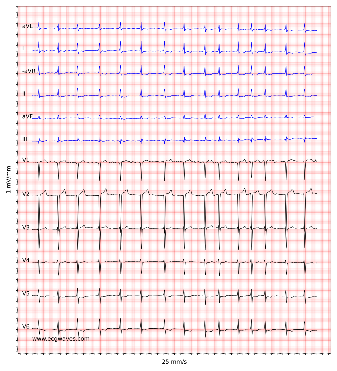 ECG-atrial-fibrillation-anterior-myocardial-infarction-non-specific-ST ...