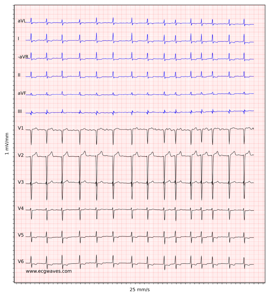 ECG-atrial-fibrillation-anterior-myocardial-infarction-non-specific-ST ...