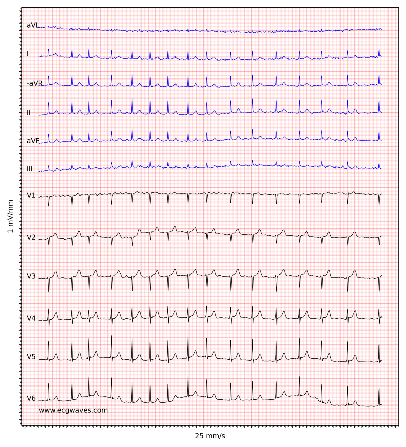 ECG-atrial-fibrillation-anteroseptal-myocardial-infarction – The ...