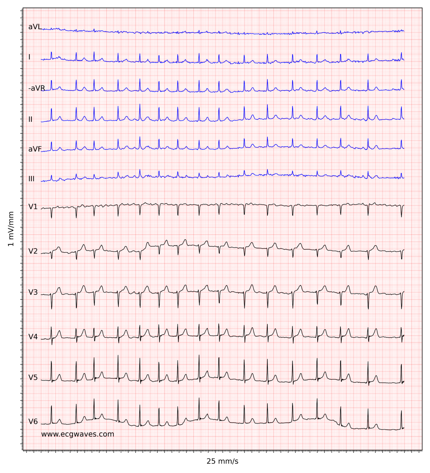 Atrial fibrillation: ECG, classification, causes, risk factors ...