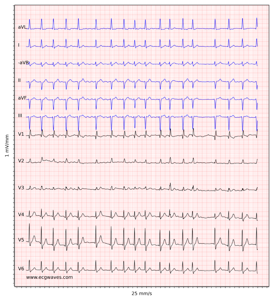 Atrial fibrillation: ECG, classification, causes, risk factors ...