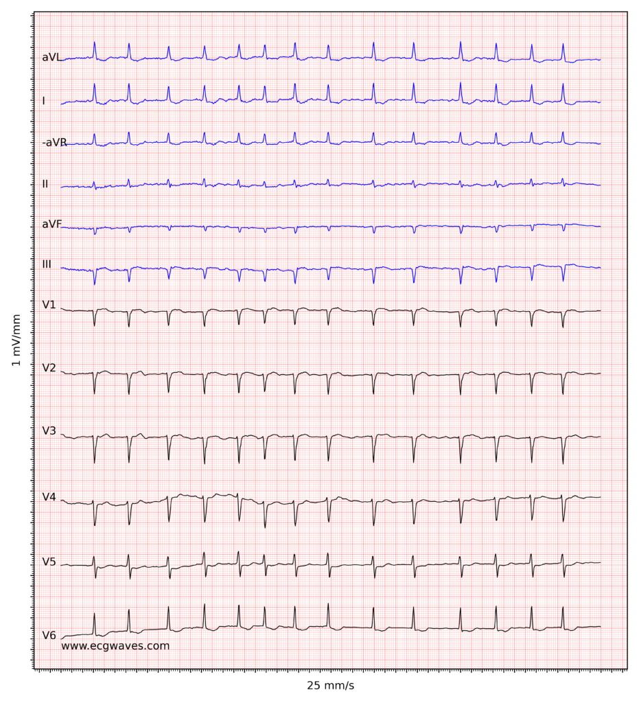 Atrial fibrillation: ECG, classification, causes, risk factors ...