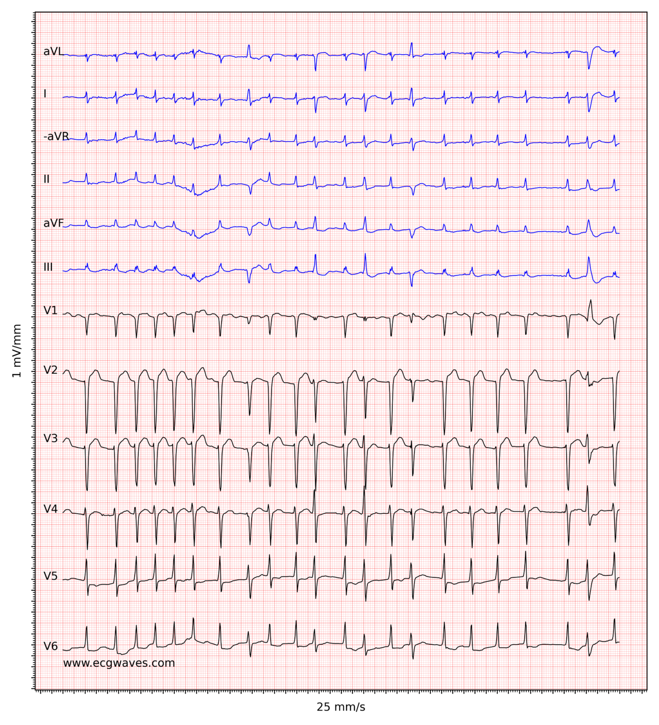 Atrial fibrillation: ECG, classification, causes, risk factors ...