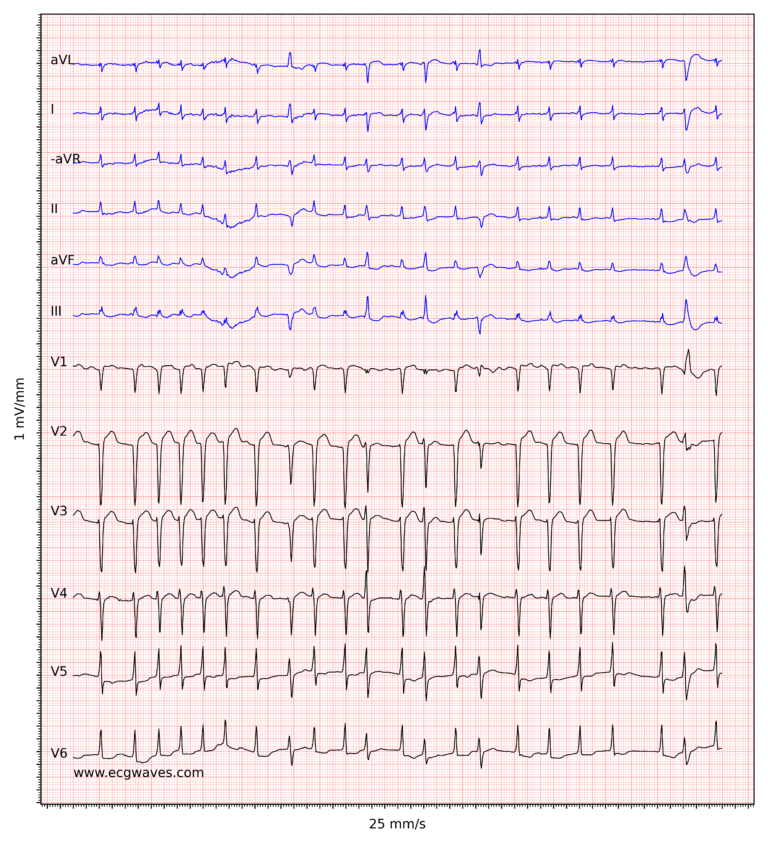 Atrial fibrillation: ECG, classification, causes, risk factors ...