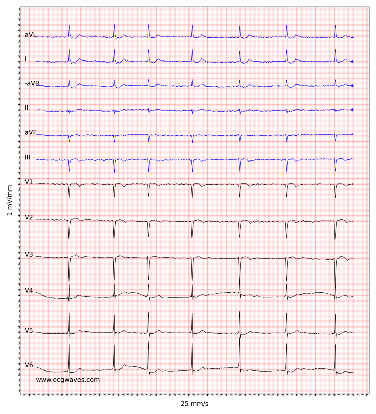 Atrial fibrillation: ECG, classification, causes, risk factors ...