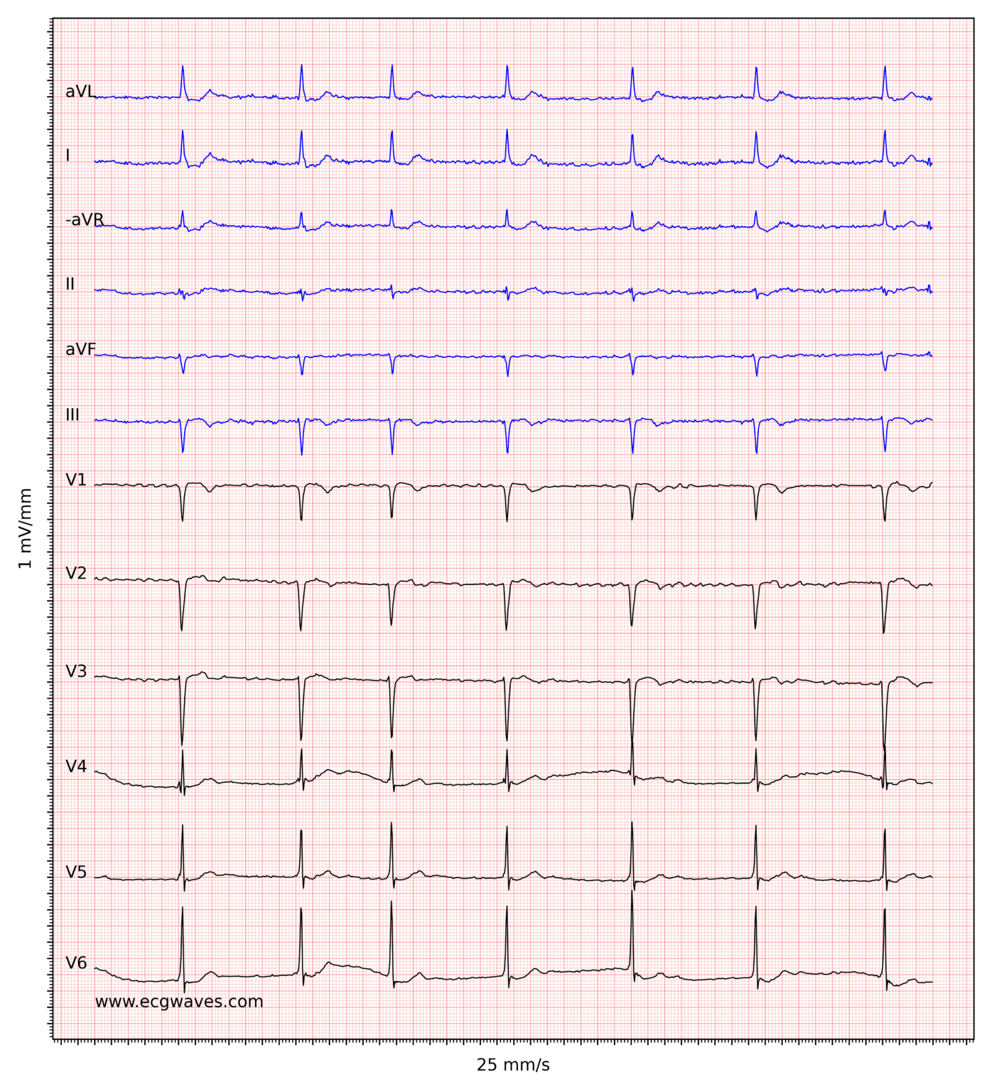 ECG-atrial-fibrillation-anteroseptal-myocardial-infarction-non-specific ...