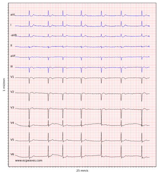 Atrial fibrillation: ECG, classification, causes, risk factors ...