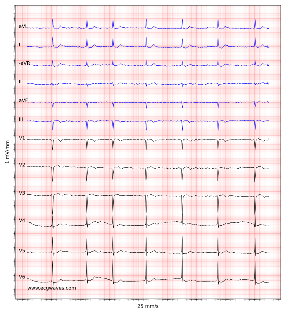 ECG-atrial-fibrillation-anteroseptal-myocardial-infarction-non-specific ...