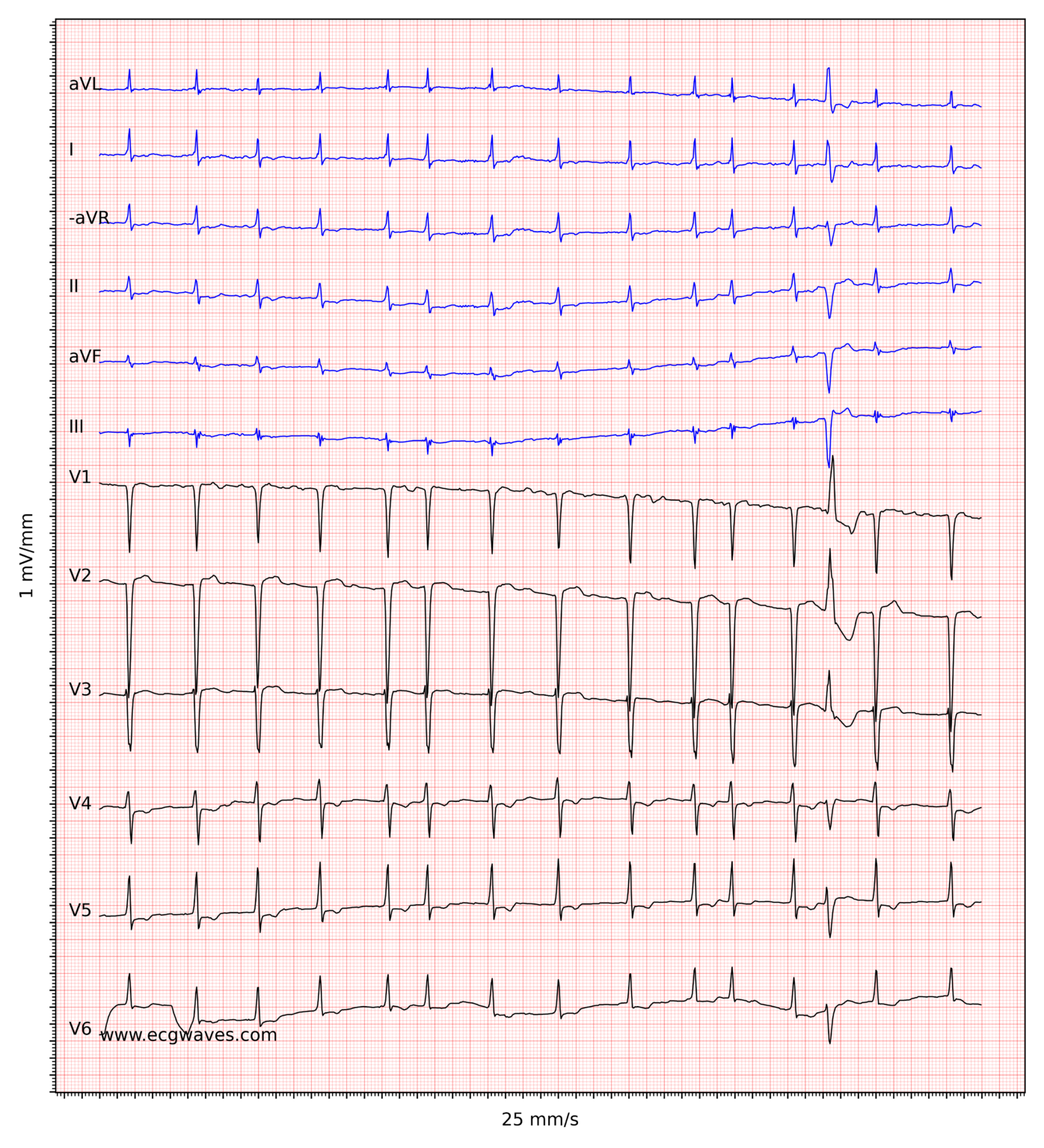 ECG-atrial-fibrillation-anteroseptal-myocardial-infarction-ventricular ...