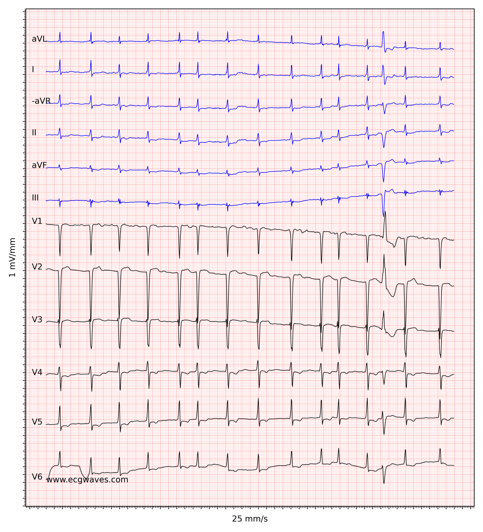 Atrial fibrillation: ECG, classification, causes, risk factors ...
