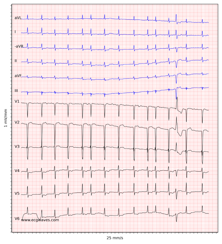 ECG-atrial-fibrillation-anteroseptal-myocardial-infarction-ventricular ...