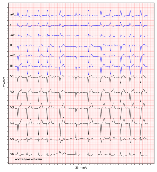 ECG-atrial-fibrillation-complete-left-bundle-branch-block – The ...