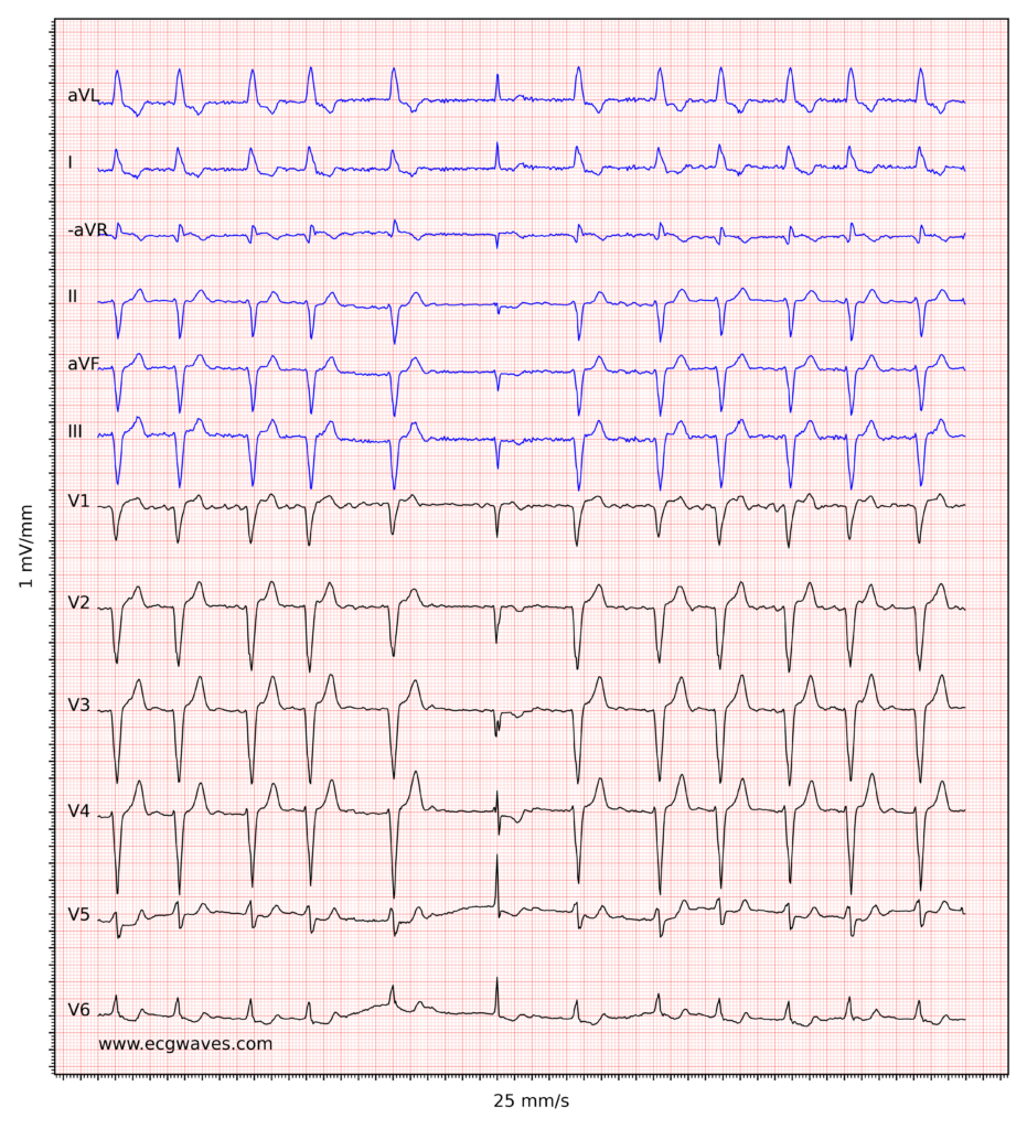 Atrial fibrillation: ECG, classification, causes, risk factors ...