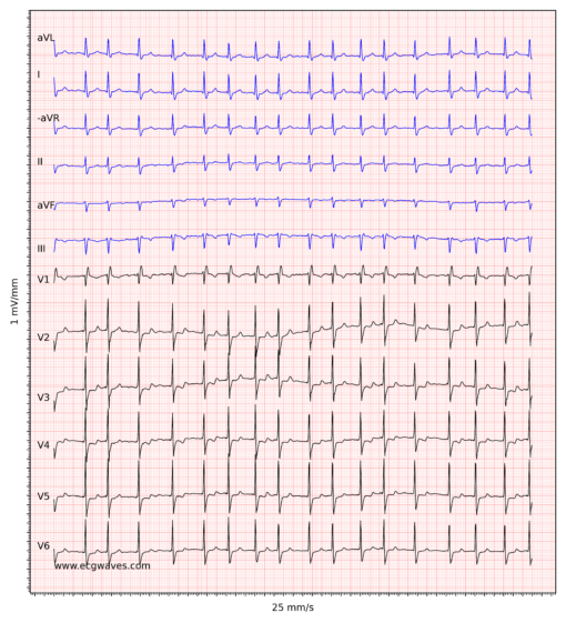 ECG-atrial-fibrillation-incomplete-right-bundle-branch-block-left ...
