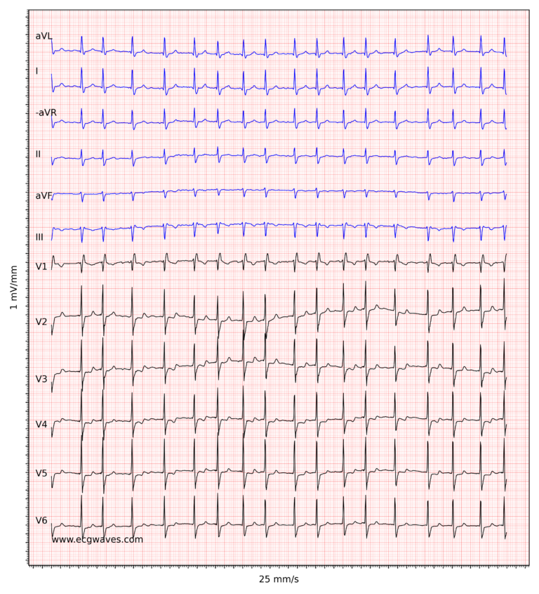 ECG-atrial-fibrillation-incomplete-right-bundle-branch-block-left ...