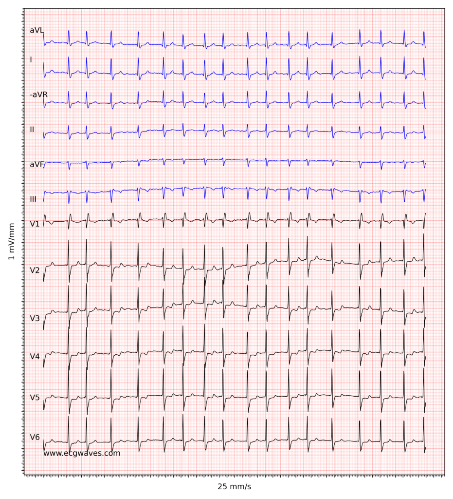 ECG-atrial-fibrillation-incomplete-right-bundle-branch-block-left ...
