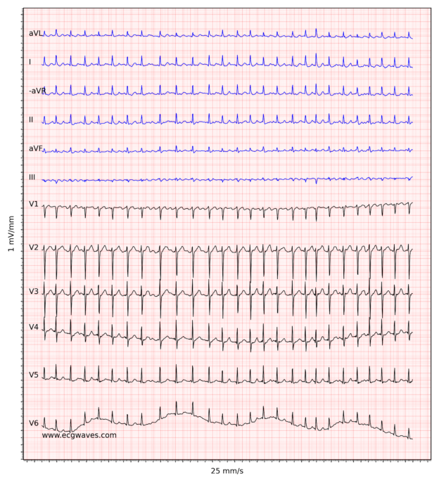 ECG-atrial-fibrillation-non-specific-ST-changes – The Cardiovascular