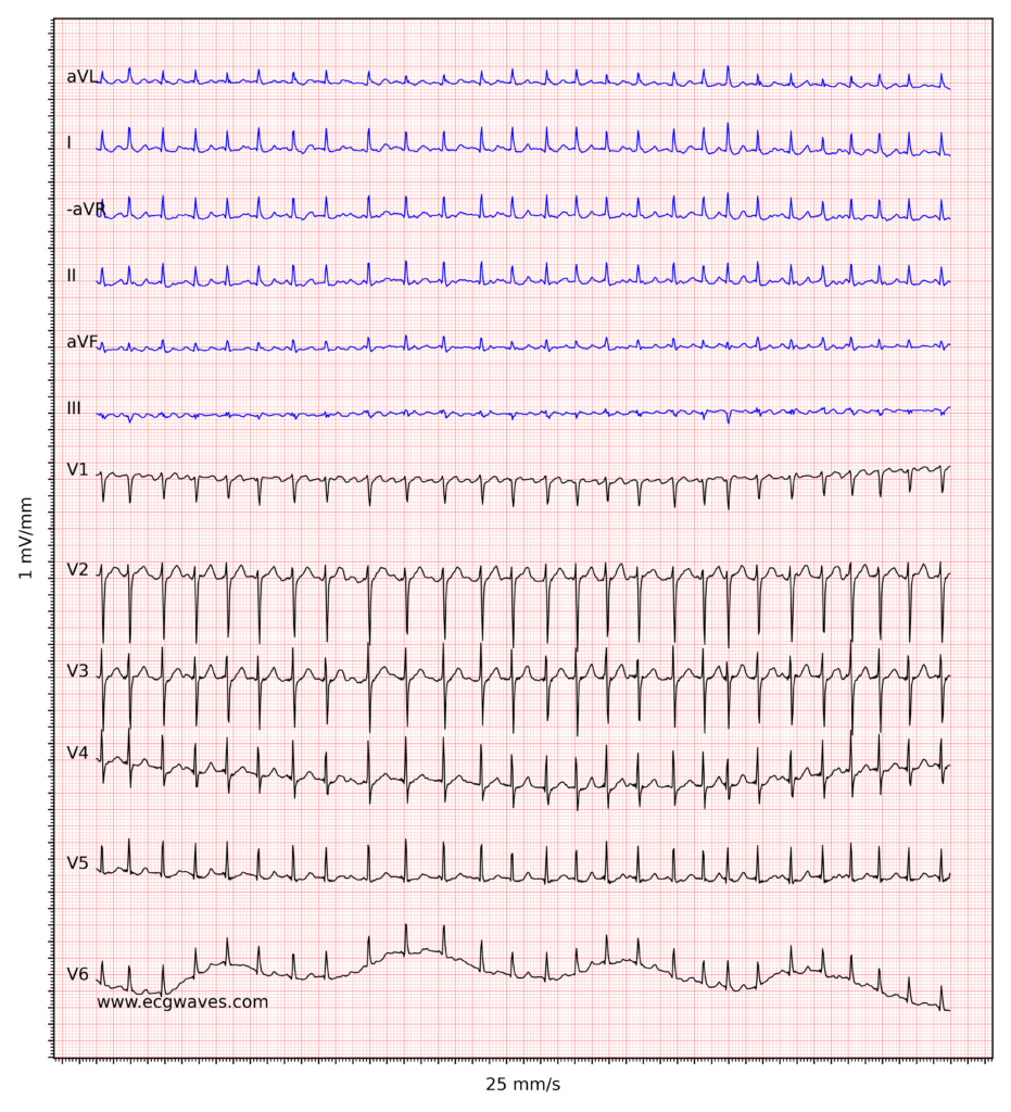 ECG-atrial-fibrillation-non-specific-ST-changes – The Cardiovascular