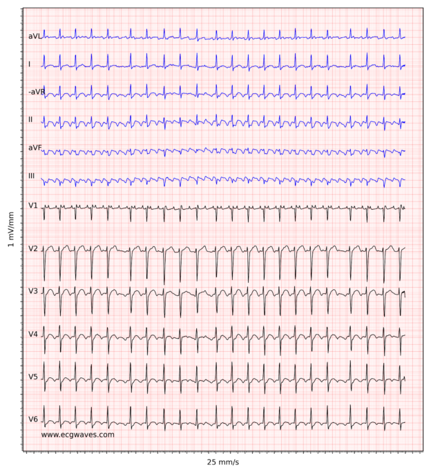 Atrial flutter: classification, causes, ECG diagnosis & management