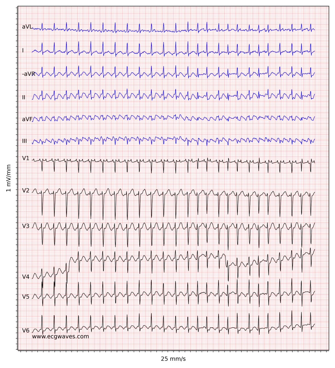 Atrial flutter: classification, causes, ECG diagnosis & management