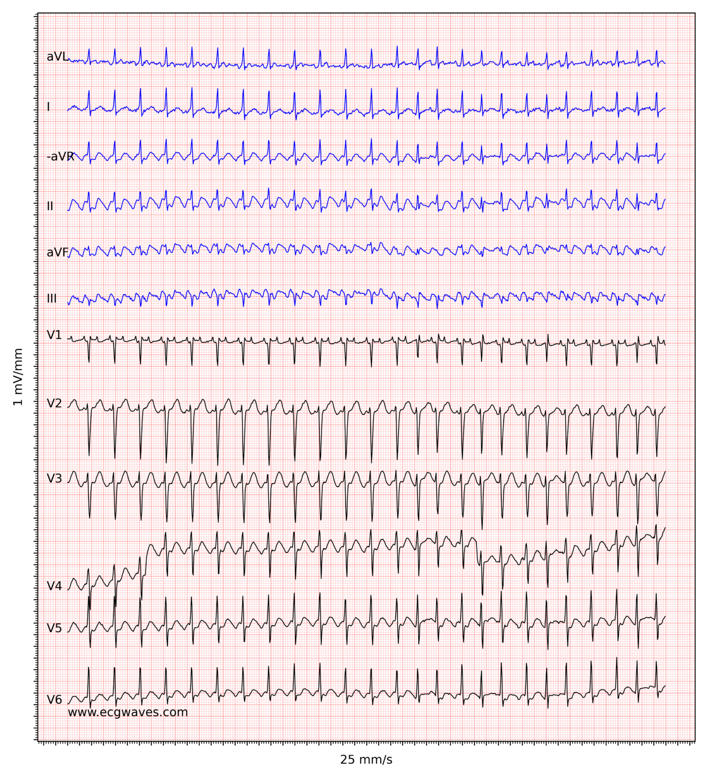 Atrial flutter: classification, causes, ECG diagnosis & management