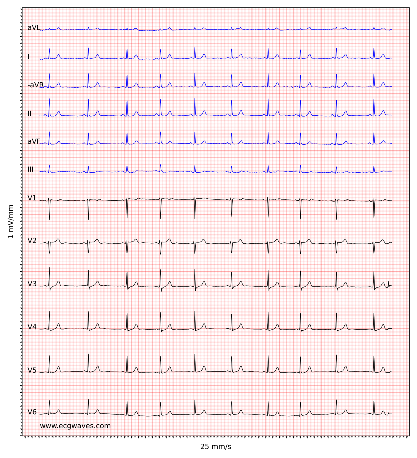 ECG interpretation: Characteristics of the normal ECG (P-wave, QRS ...