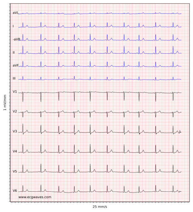 ECG interpretation: Characteristics of the normal ECG (P-wave, QRS ...