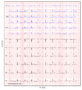 ECG interpretation: Characteristics of the normal ECG (P-wave, QRS ...
