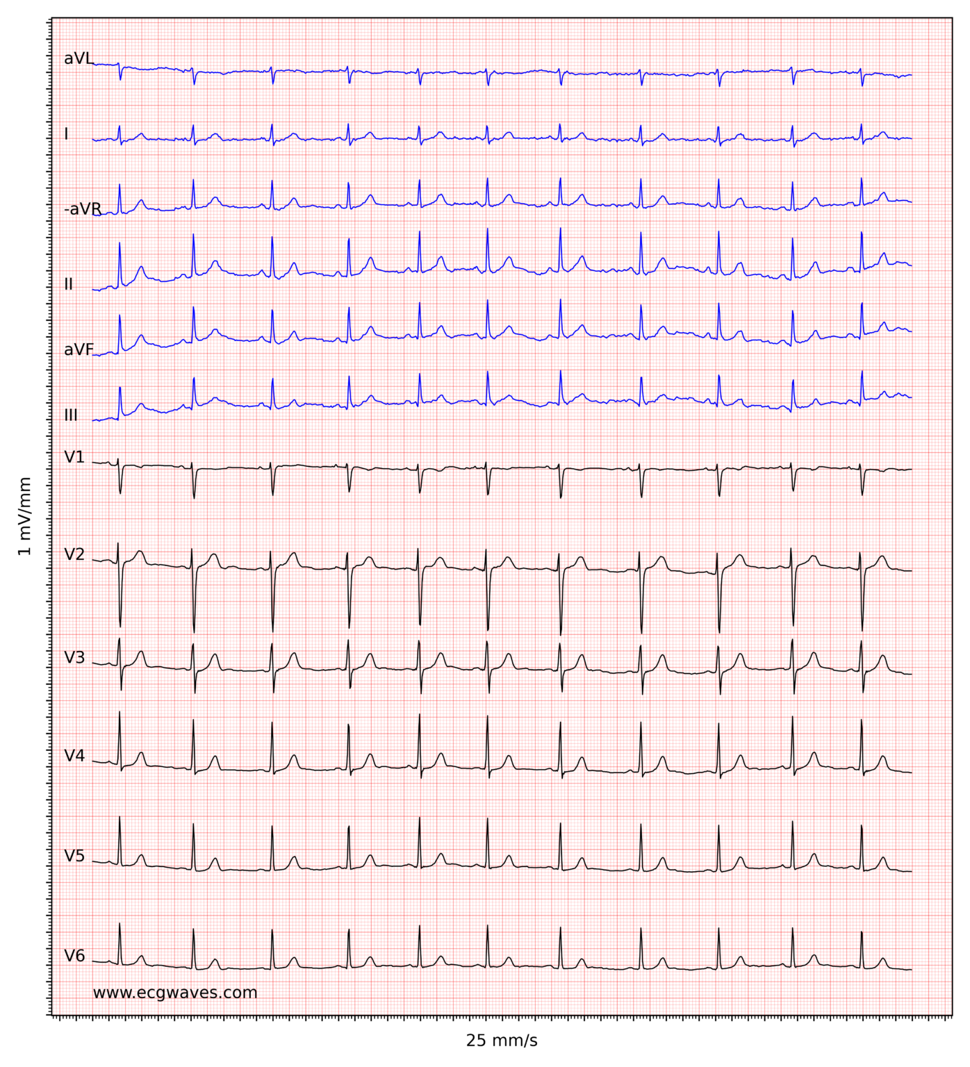 ECG interpretation: Characteristics of the normal ECG (P-wave, QRS ...