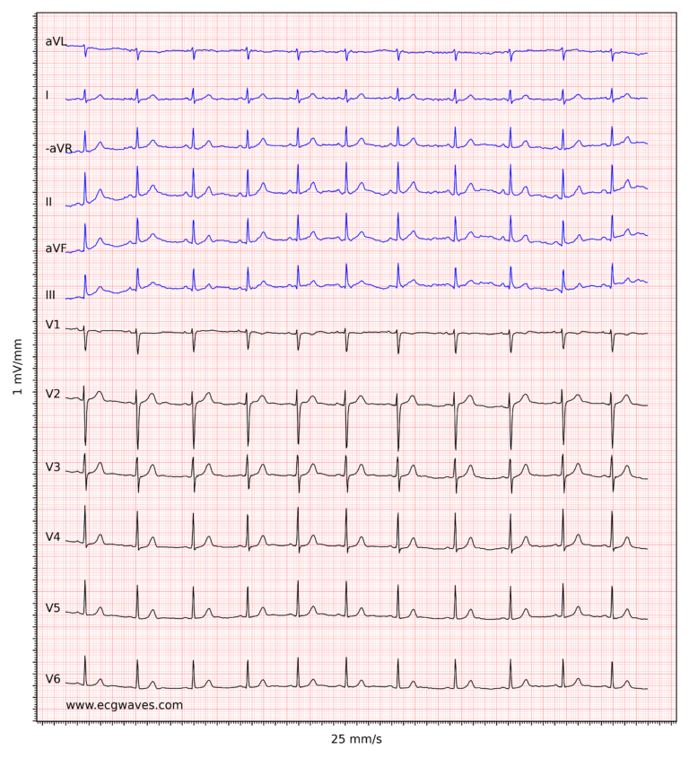 ECG interpretation: Characteristics of the normal ECG (P-wave, QRS ...