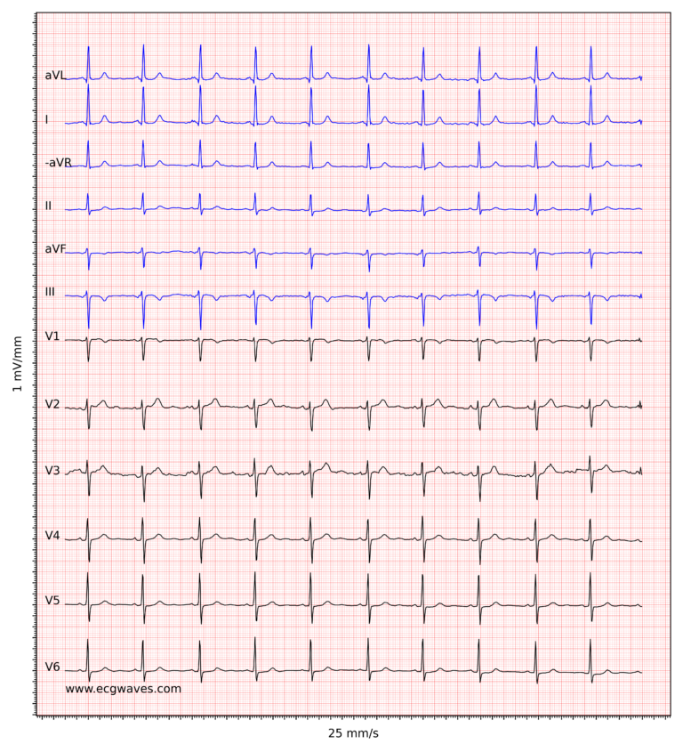ECG interpretation: Characteristics of the normal ECG (P-wave, QRS ...