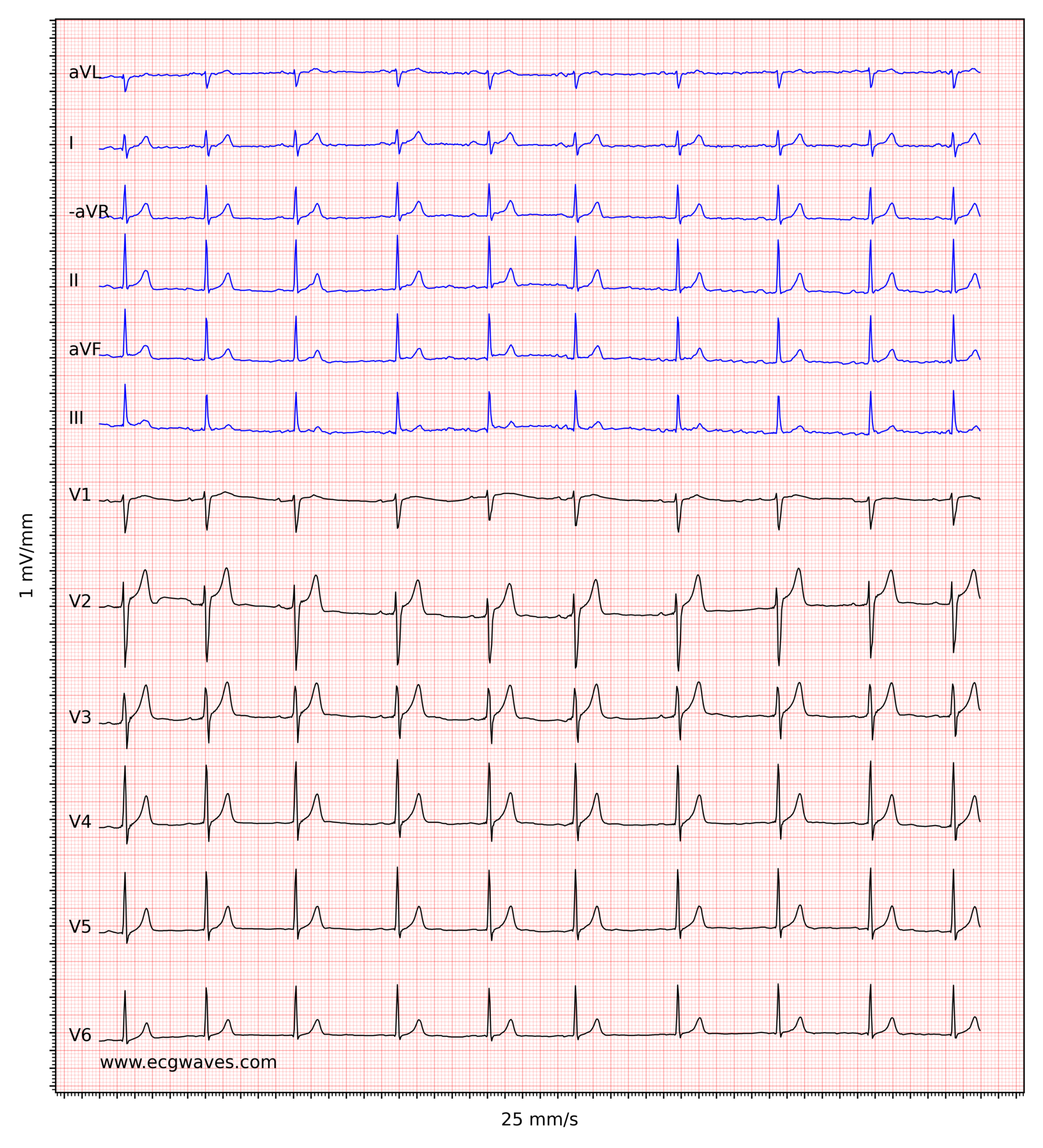 ECG interpretation: Characteristics of the normal ECG (P-wave, QRS ...