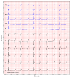 ECG interpretation: Characteristics of the normal ECG (P-wave, QRS ...