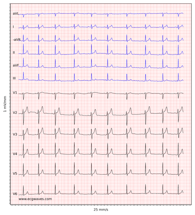 ECG interpretation: Characteristics of the normal ECG (P-wave, QRS ...